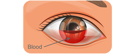 Hyphema (Bleeding in the eye) | Sidra Medicine